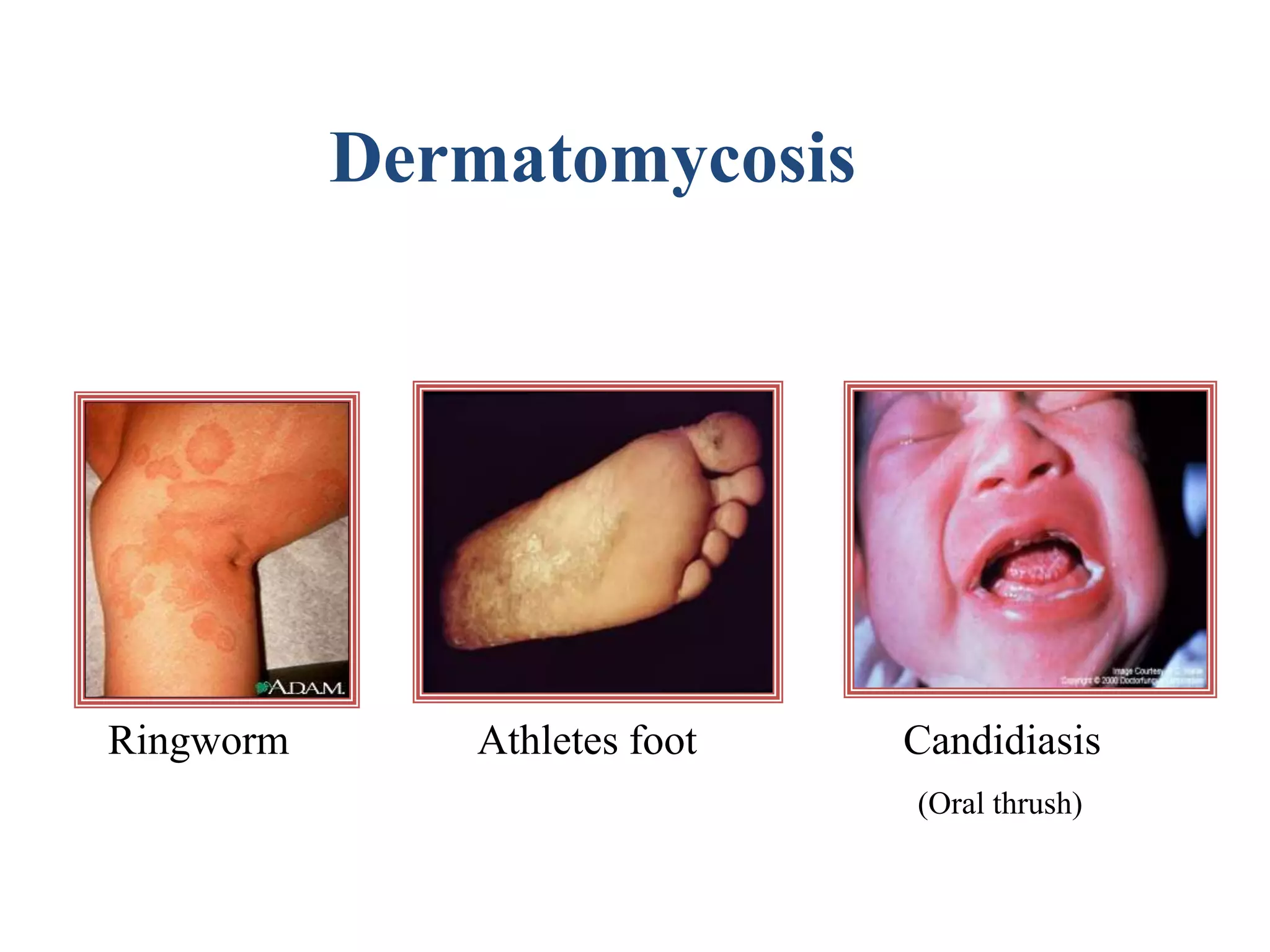 (14)Dermatomycosis Unit VI.pptx