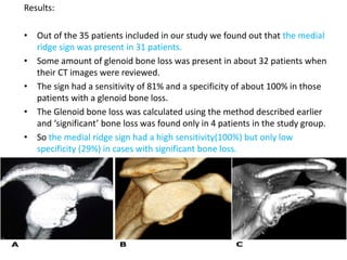 Is Medial Ridge Sign a Reliable Indicator Glenoid Bone Loss-Dr ...