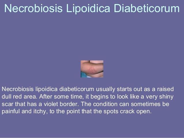 Diabetic Dermatitis: Just One Of The Many Diabetes Induced Skin Probl…