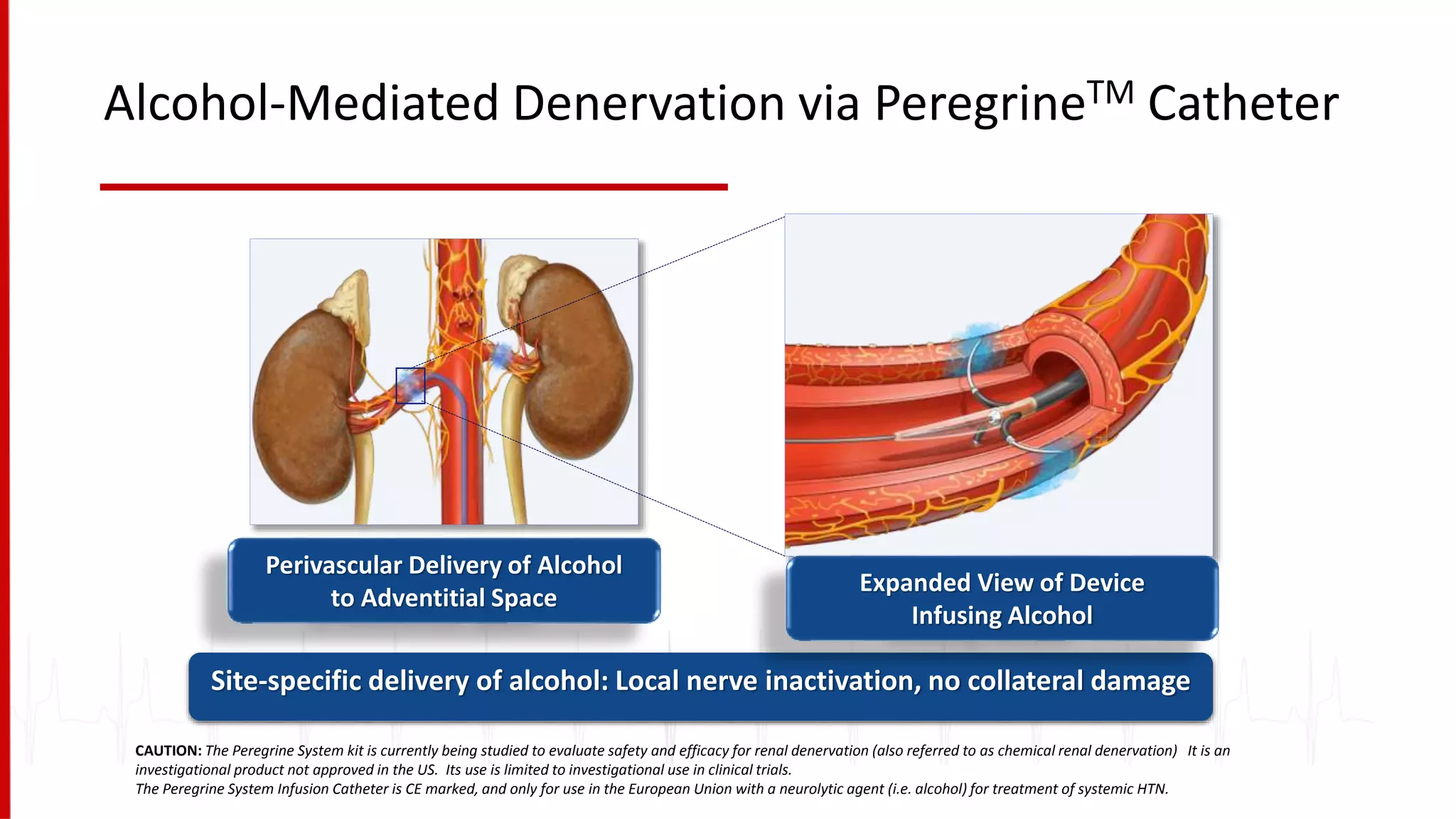 PCI & AimRadial 2018 | Innovation in Cardiovascular Medicine - Tim A ...