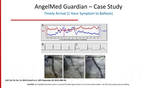 PCI & AimRadial 2018 | Innovation in Cardiovascular Medicine - Tim A ...