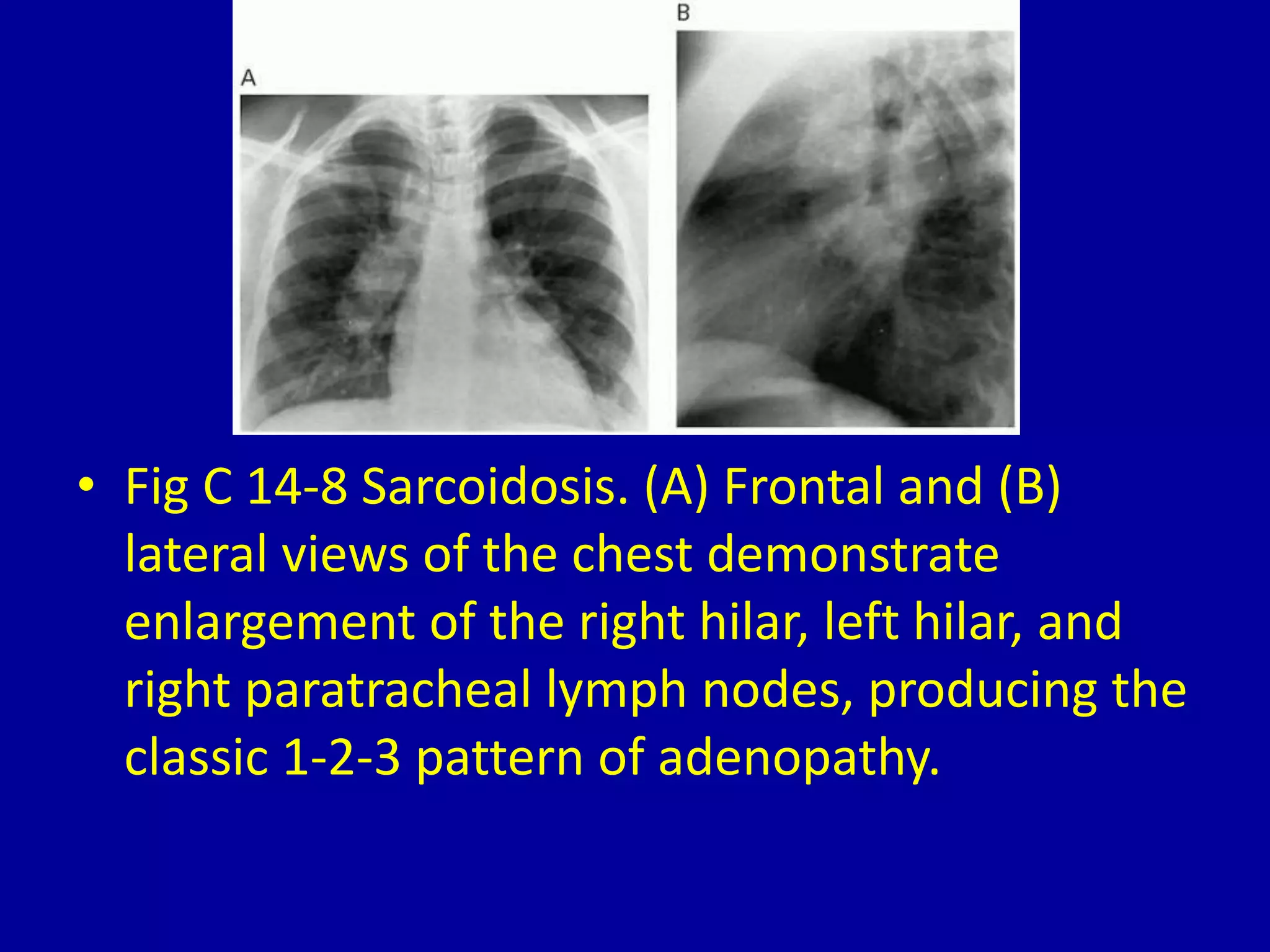 14 hilar and mediastinal lymph node enlargement | PPTX