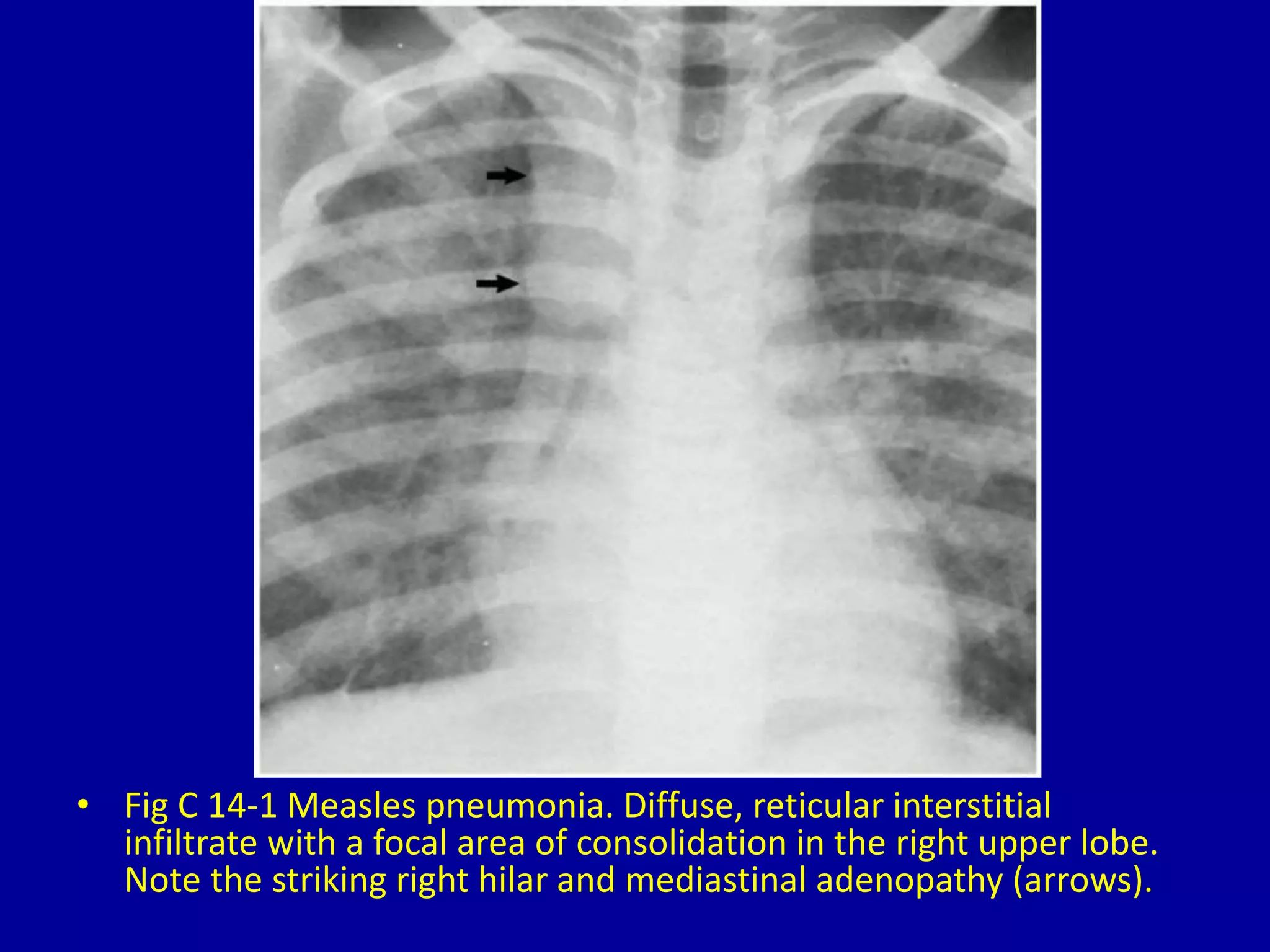 14 hilar and mediastinal lymph node enlargement | PPTX