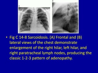 14 hilar and mediastinal lymph node enlargement | PPTX | Lung and ...
