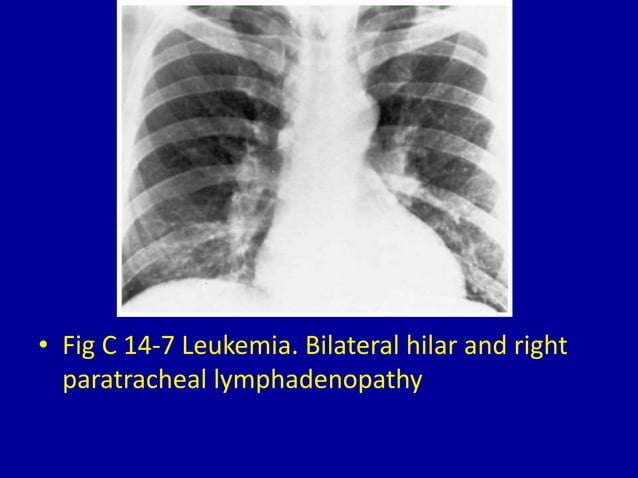 14 hilar and mediastinal lymph node enlargement