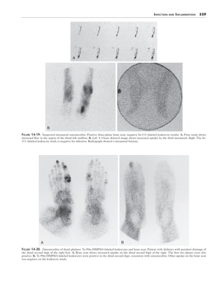 14 infection inflammation | PDF