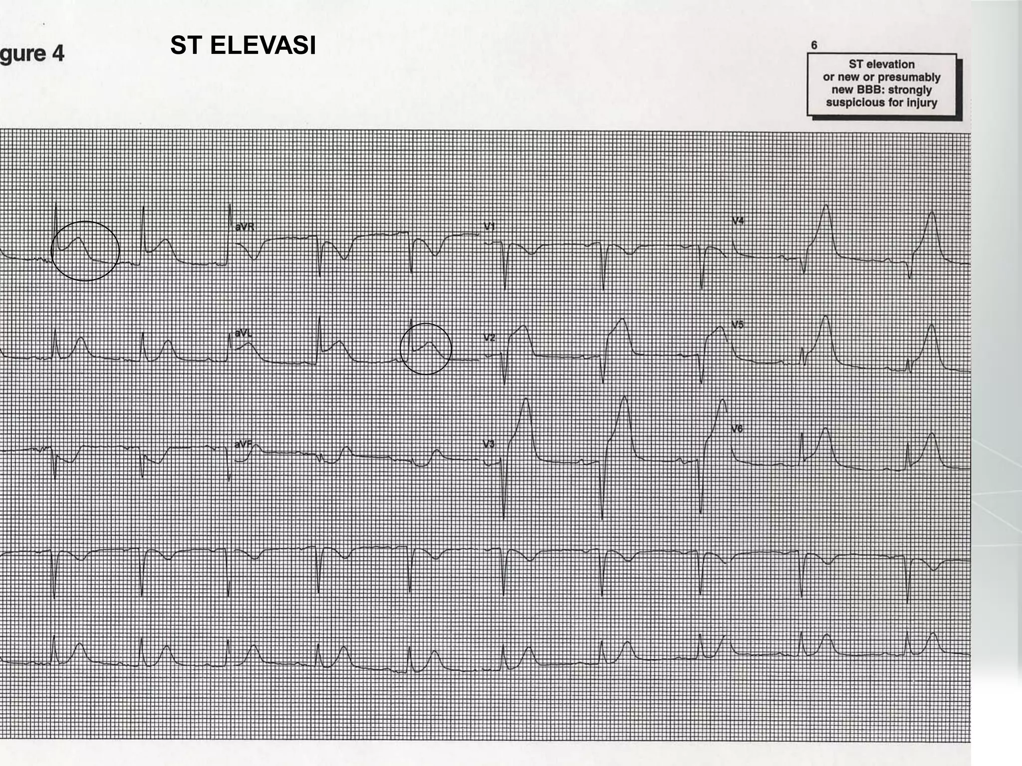 14 Konsep Dasar EKG | PDF
