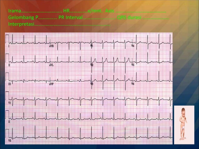 14 Konsep Dasar EKG | PDF