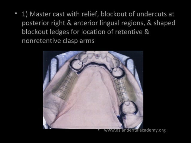 lab procedures in removable partial dentures | PPT