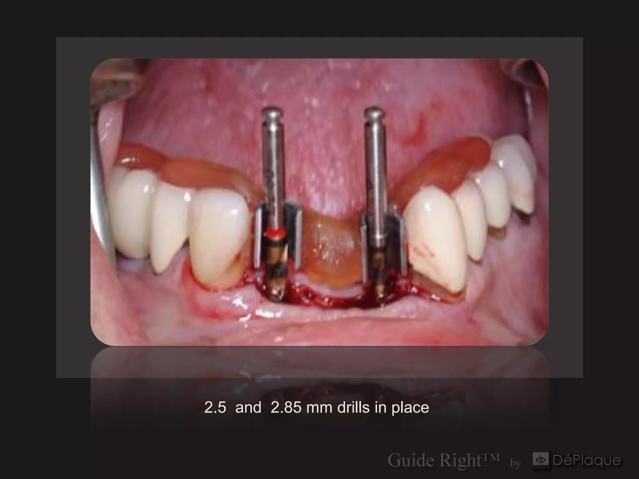 14 mandibular anterior case open guide sleeve drill progression | PPT