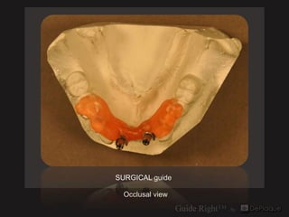 14 mandibular anterior case open guide sleeve drill progression | PPT