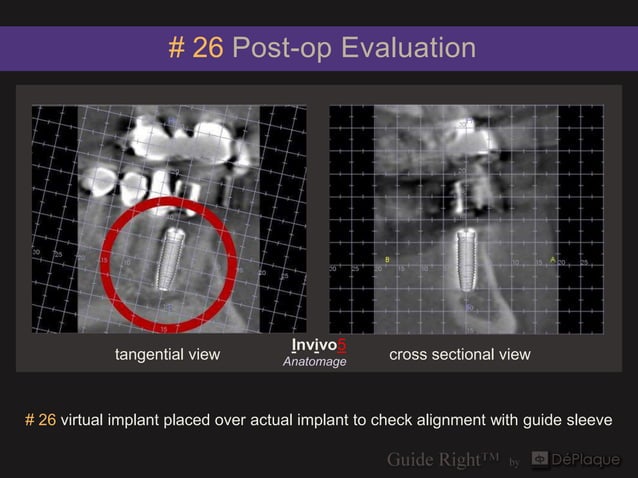 14 mandibular anterior case open guide sleeve drill progression | PPT