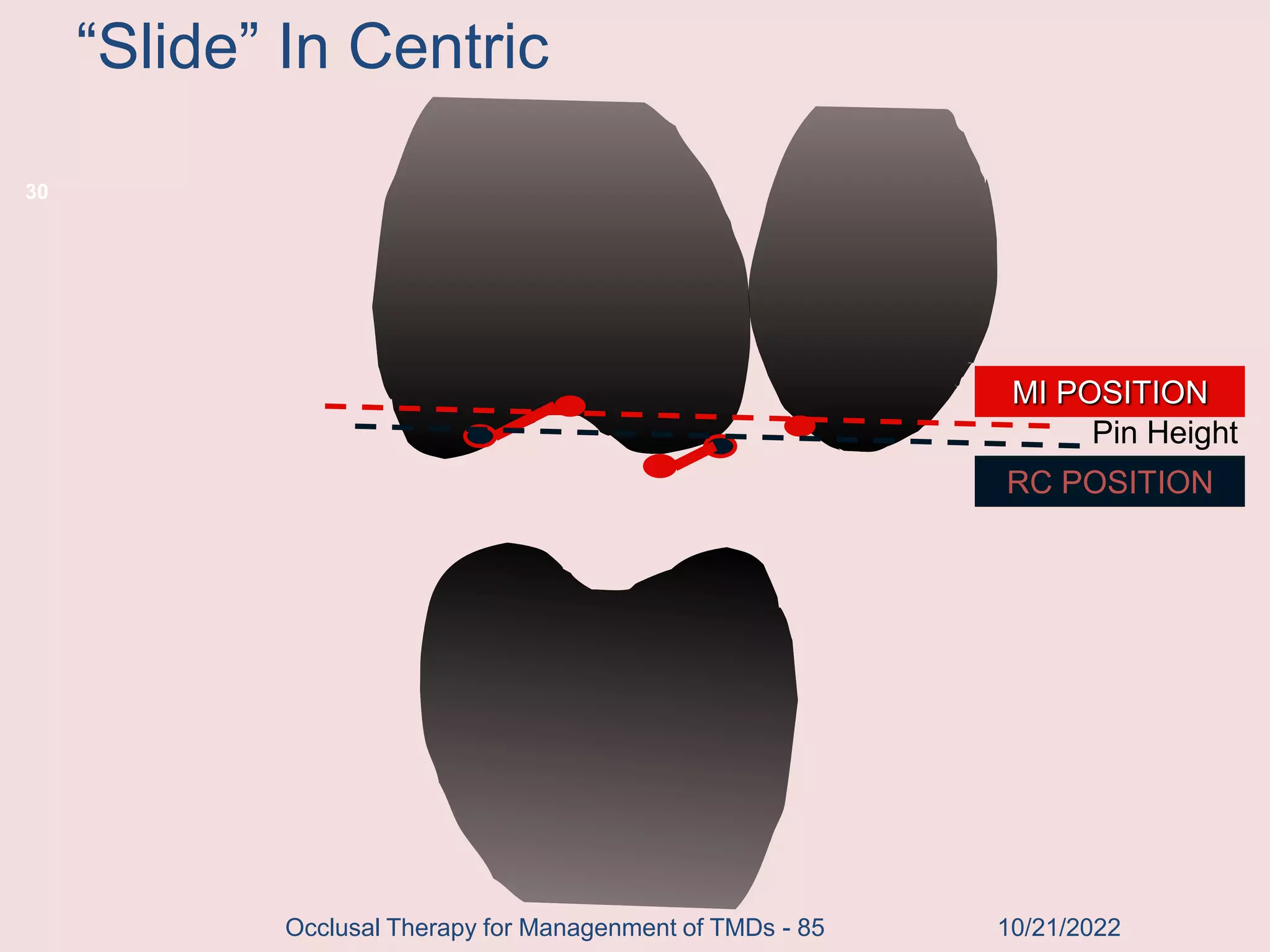 14 Occlusal therapy for management of TMDs.pptx