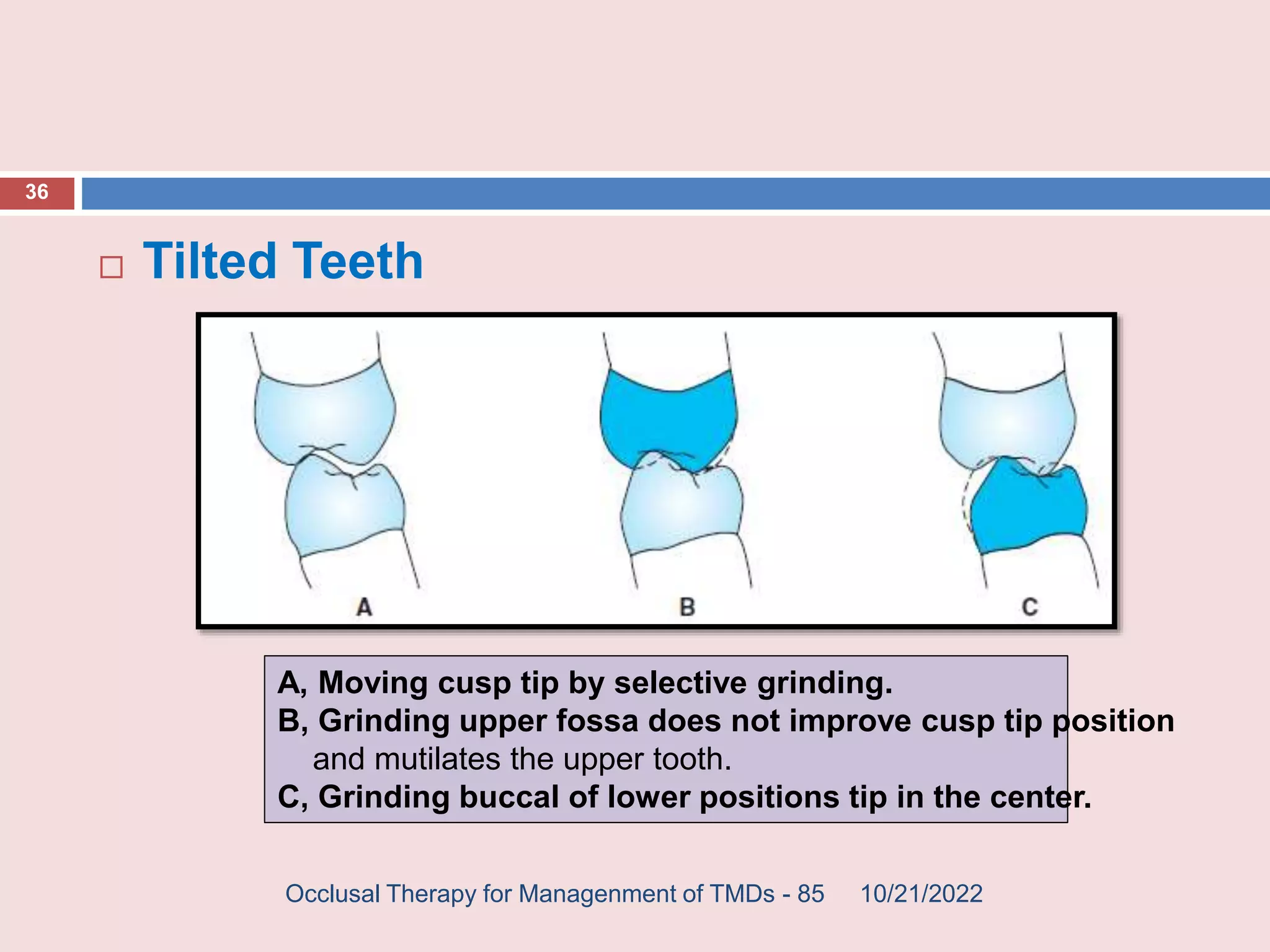 14 Occlusal therapy for management of TMDs.pptx