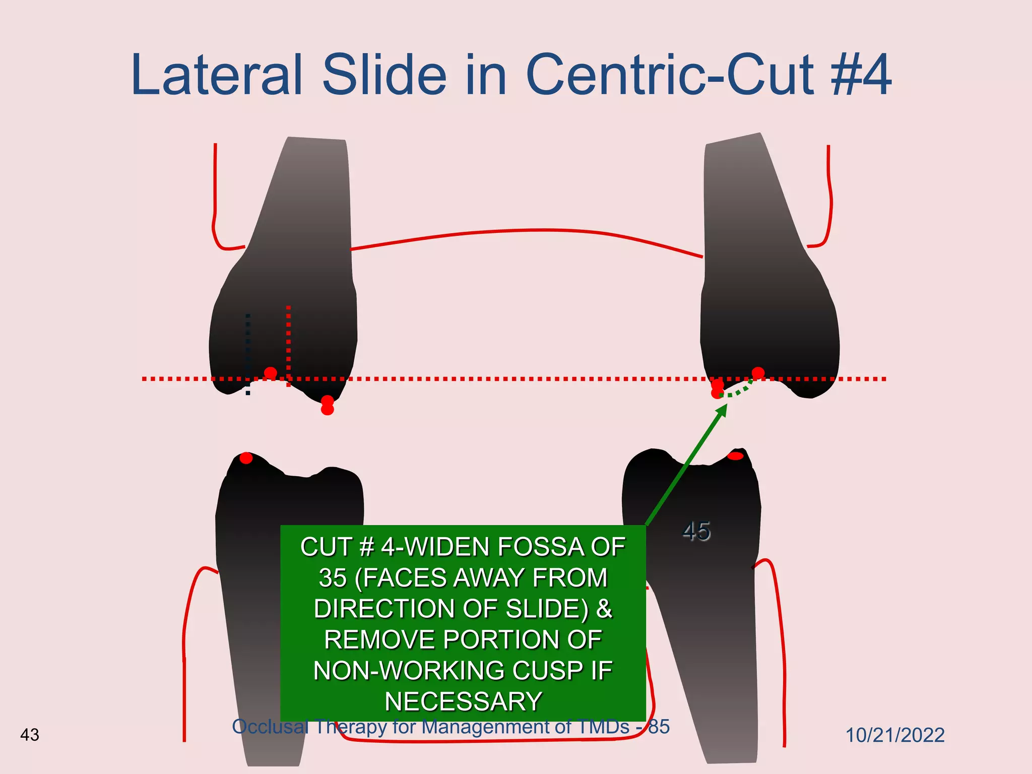 14 Occlusal therapy for management of TMDs.pptx