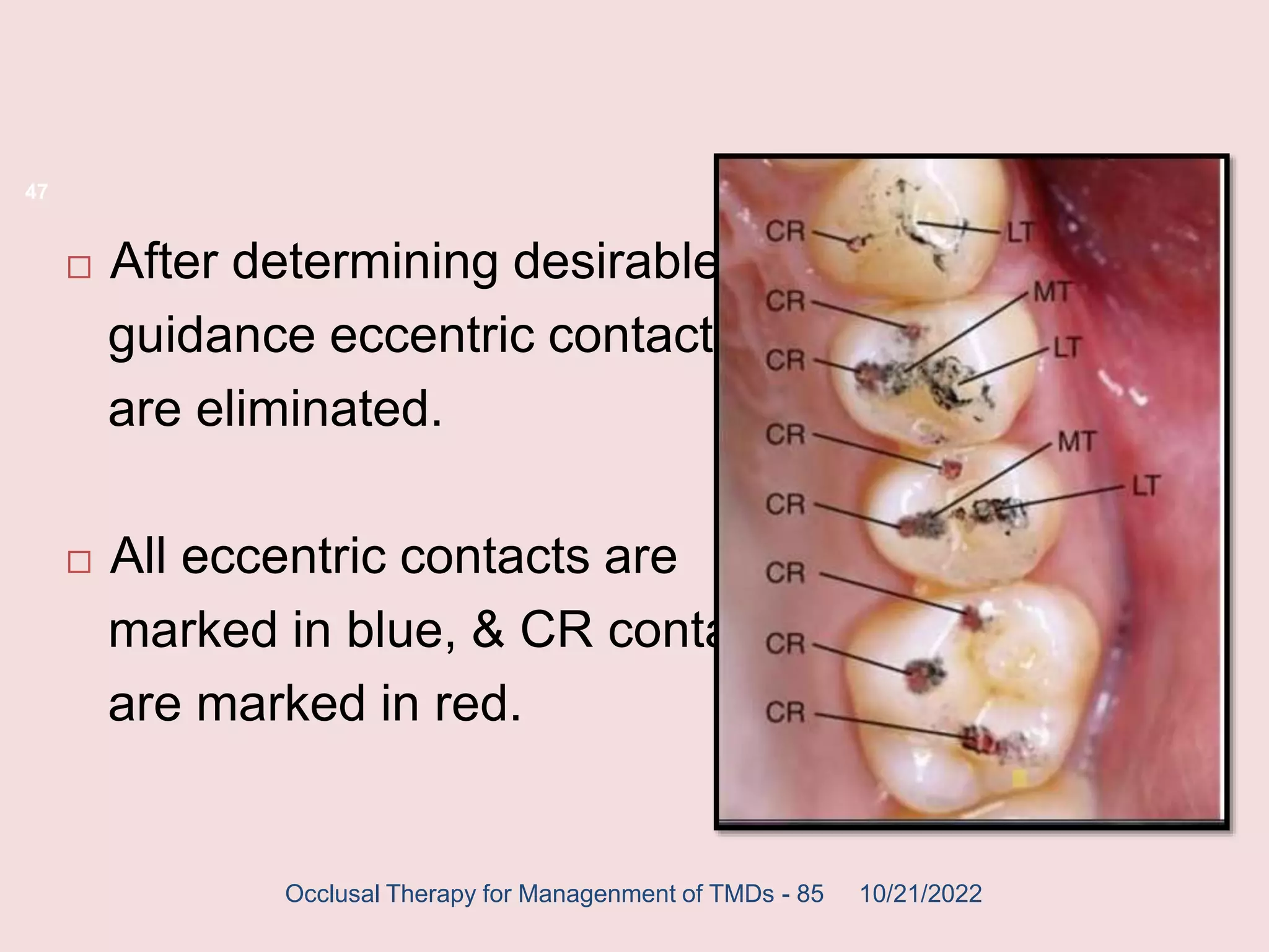 14 Occlusal therapy for management of TMDs.pptx