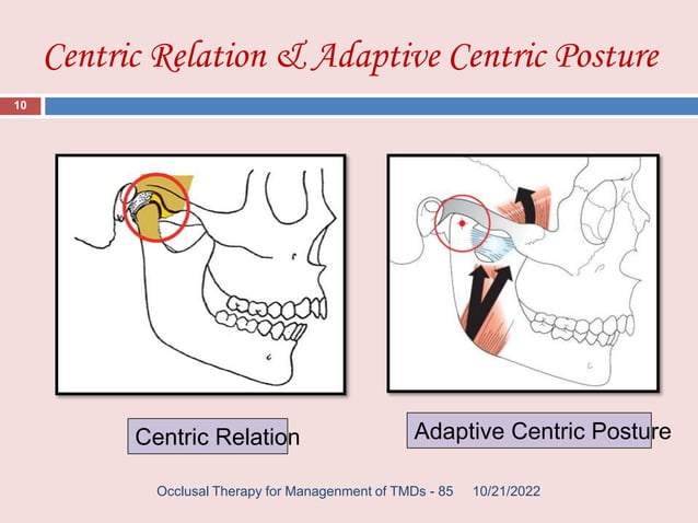 14 Occlusal therapy for management of TMDs.pptx | Physical Therapy ...
