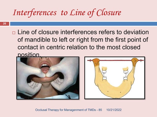 14 Occlusal therapy for management of TMDs.pptx | Physical Therapy ...