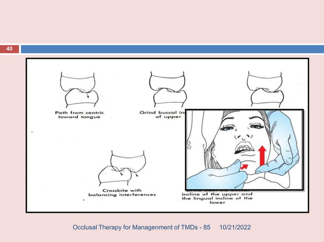 14 Occlusal therapy for management of TMDs.pptx | Physical Therapy ...