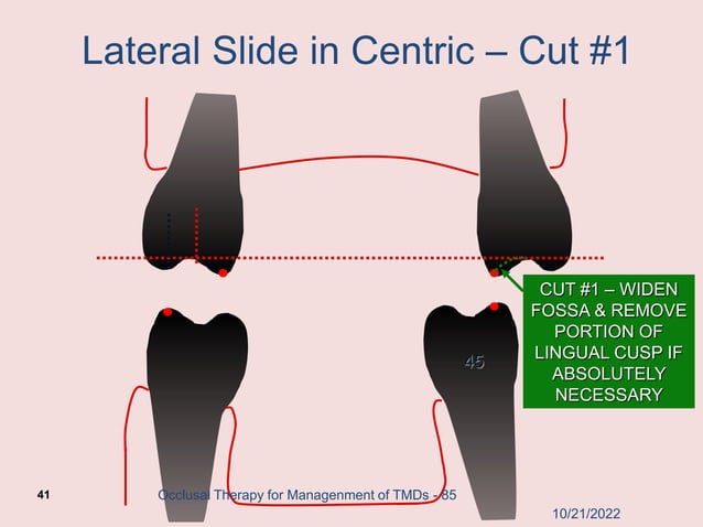 14 Occlusal therapy for management of TMDs.pptx | Physical Therapy ...