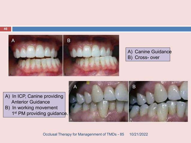 14 Occlusal therapy for management of TMDs.pptx | Physical Therapy ...