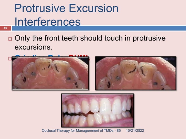 14 Occlusal therapy for management of TMDs.pptx | Physical Therapy ...