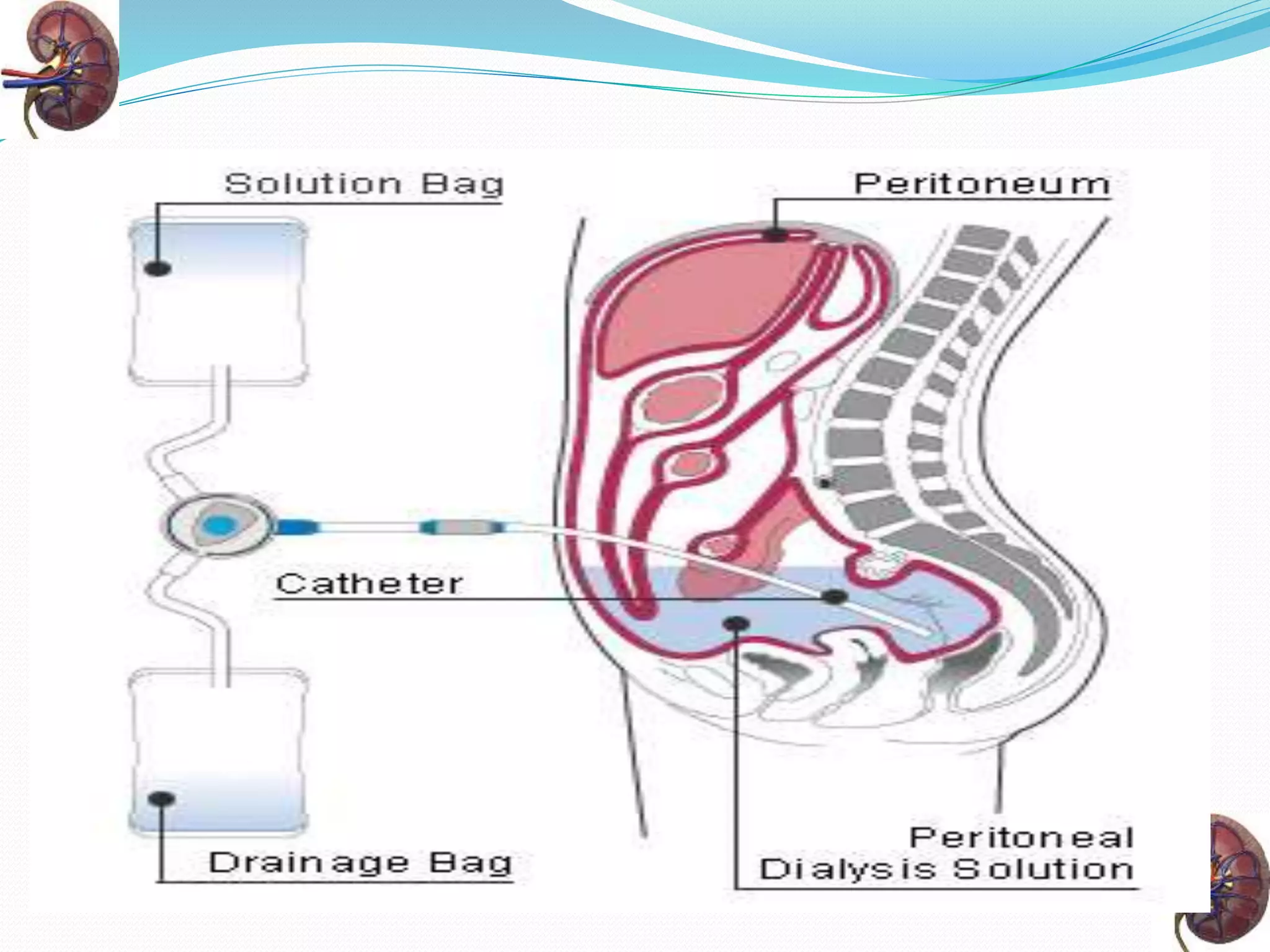 14 peritoneal dialysis | PPTX