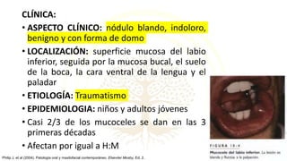 TRASTORNOS DE LAS GLÁNDULAS SALIVALES | PPTX
