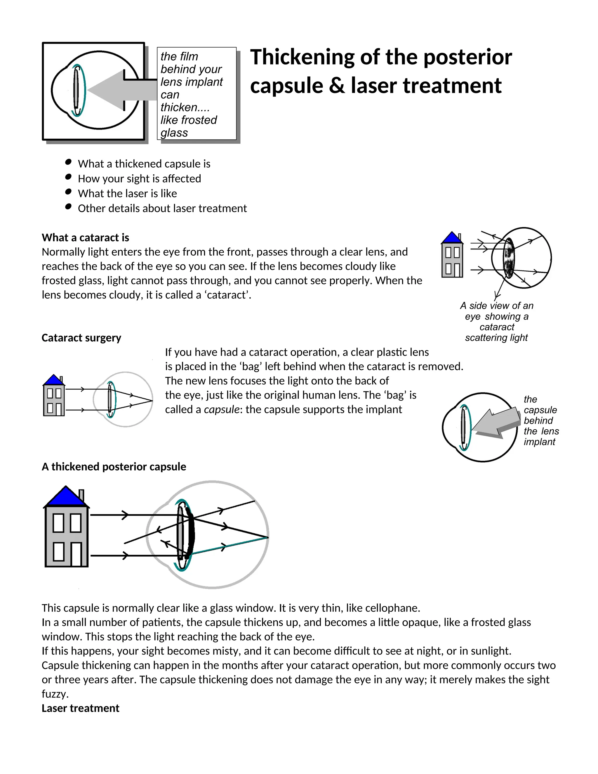 14 Thickening of the posterior capsule and laser treatment.docx