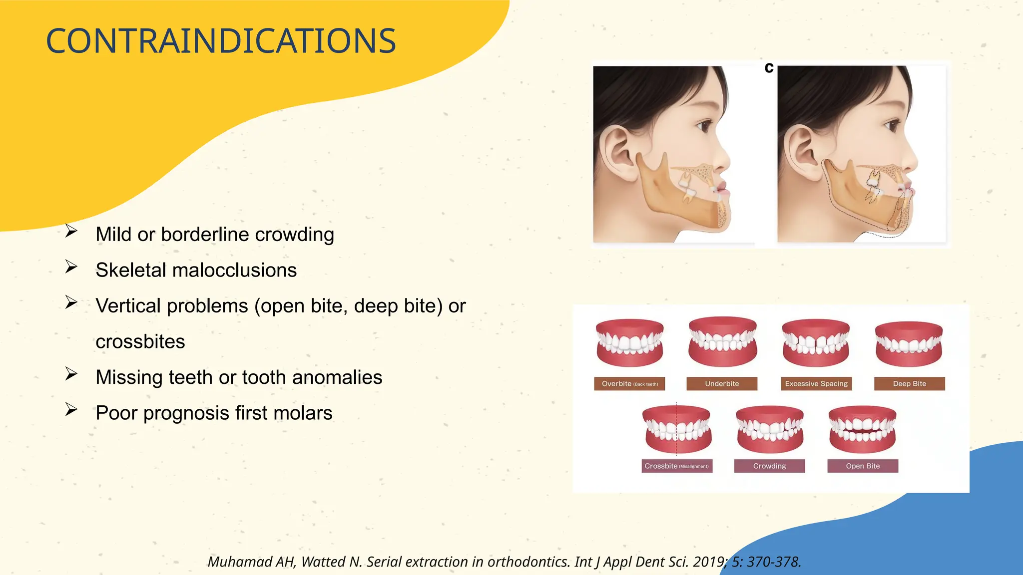 Serial Extraction- A Planned Orthodontic Approach In Paediatric ...