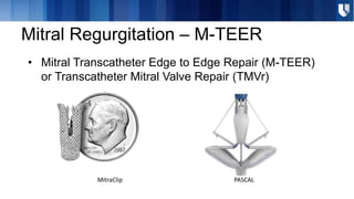 Percutaneous Valve Therapies in Heart Failure | PPTX