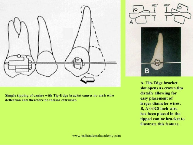 14 use of a tip edge stage- (2)