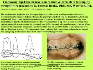 Use of a Tip Edge Stage /certified fixed orthodontic courses by Indian ...