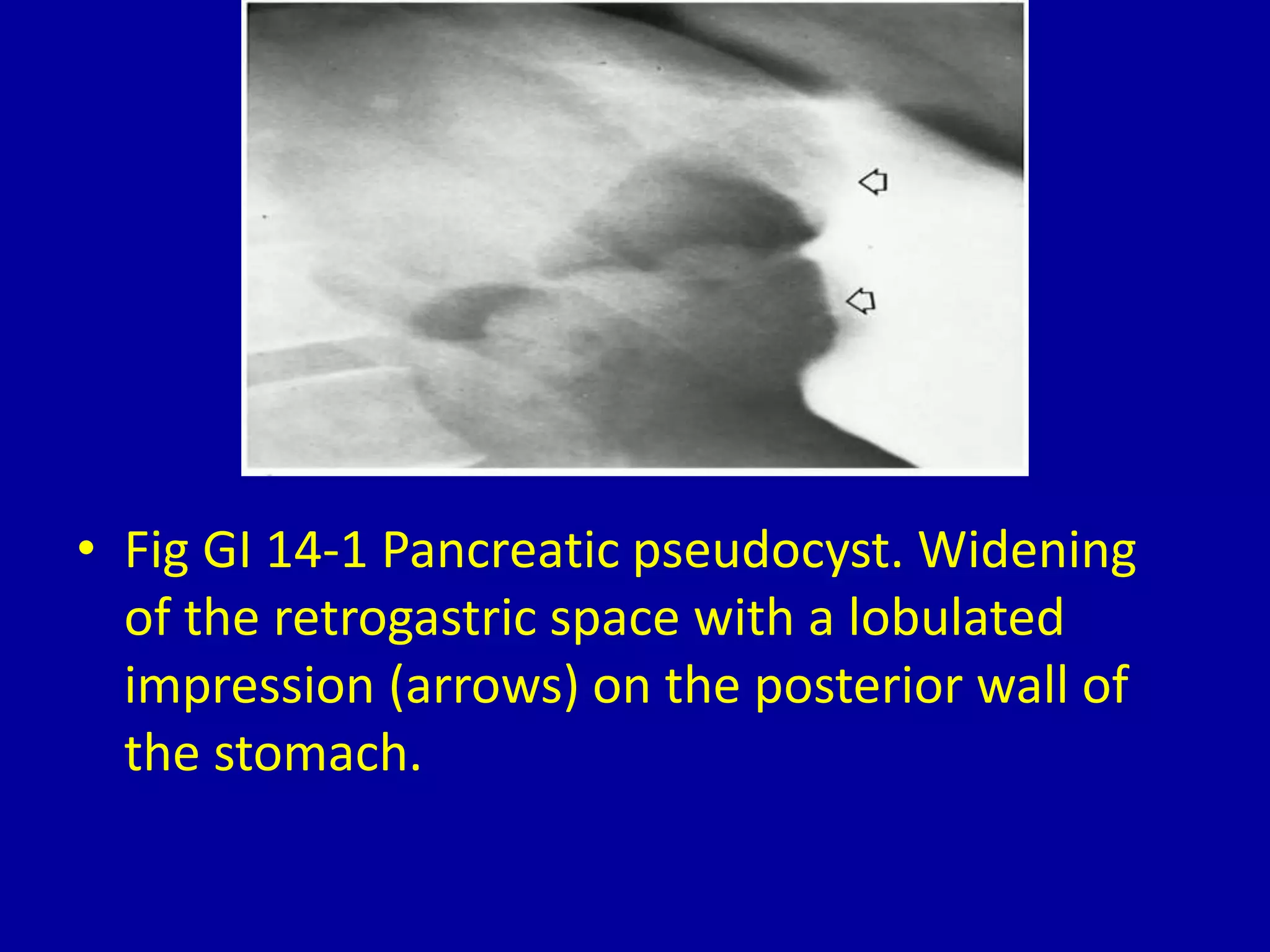14 widening of the retrogastric space | PPT | Free Download