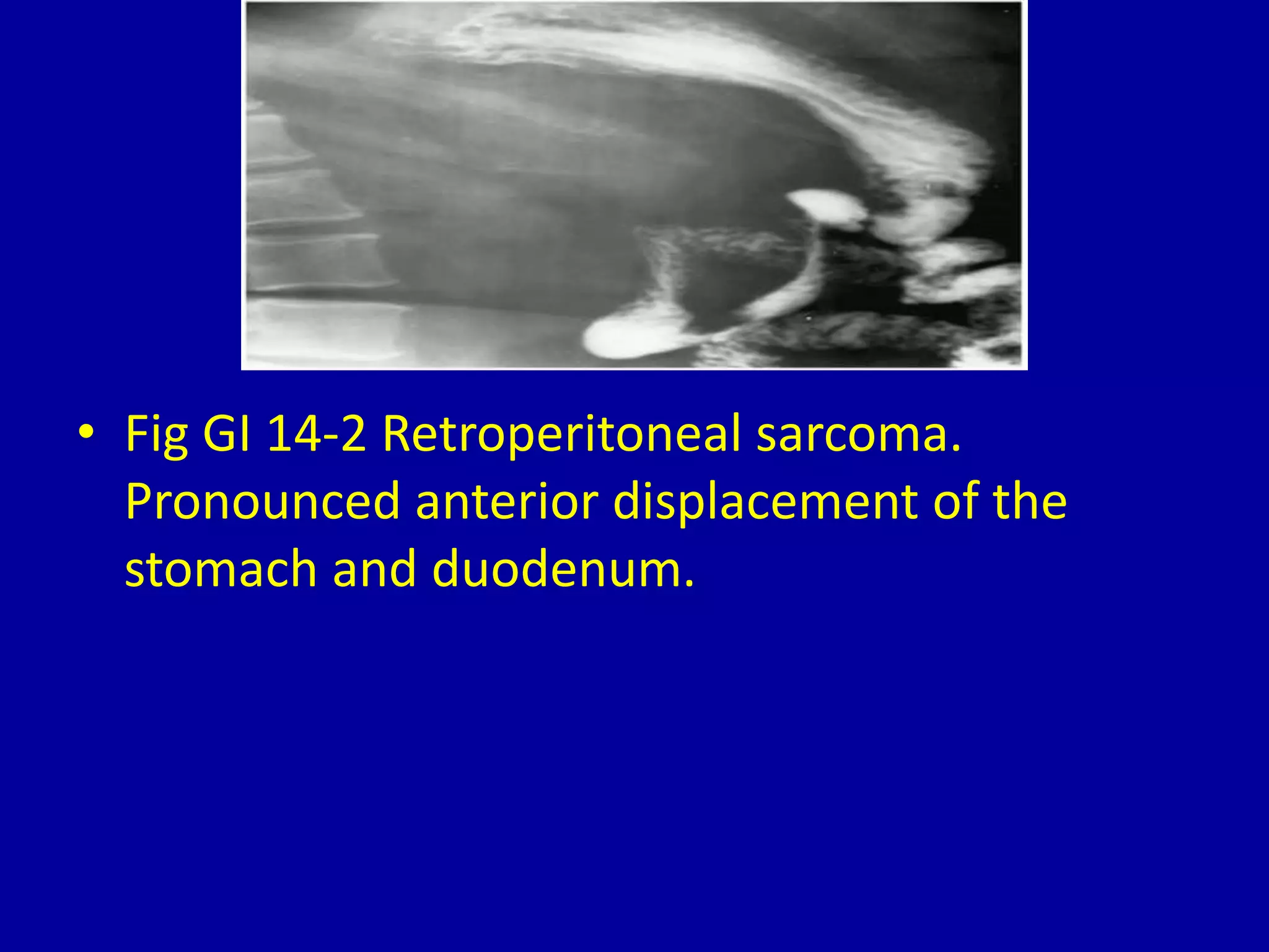 14 widening of the retrogastric space | PPTX