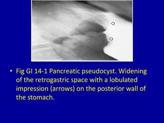 14 widening of the retrogastric space | PPT