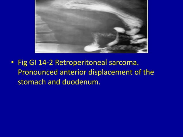 14 widening of the retrogastric space | PPT