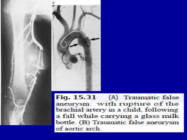 15 DAVID SUTTON PICTURES Arteriography and Intervewntional Radiology | PPTX