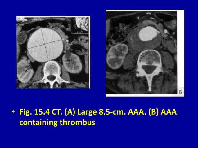 15 DAVID SUTTON PICTURES Arteriography and Intervewntional Radiology | PPTX