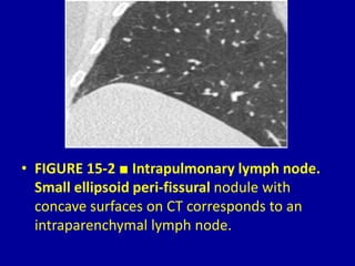 15 Pulmonary Neoplasms Dr. Muhammad Bin Zulfiqar | PPTX