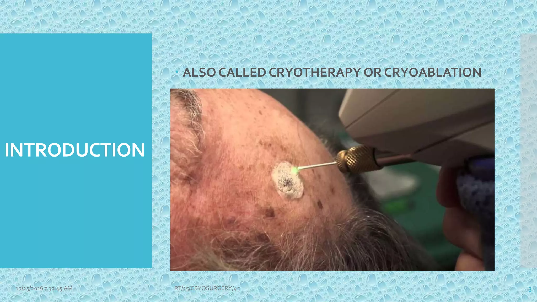 15. cryosurgery and cryotherapy (45) Dr Rahul Tiwari OMFS SIBAR ...
