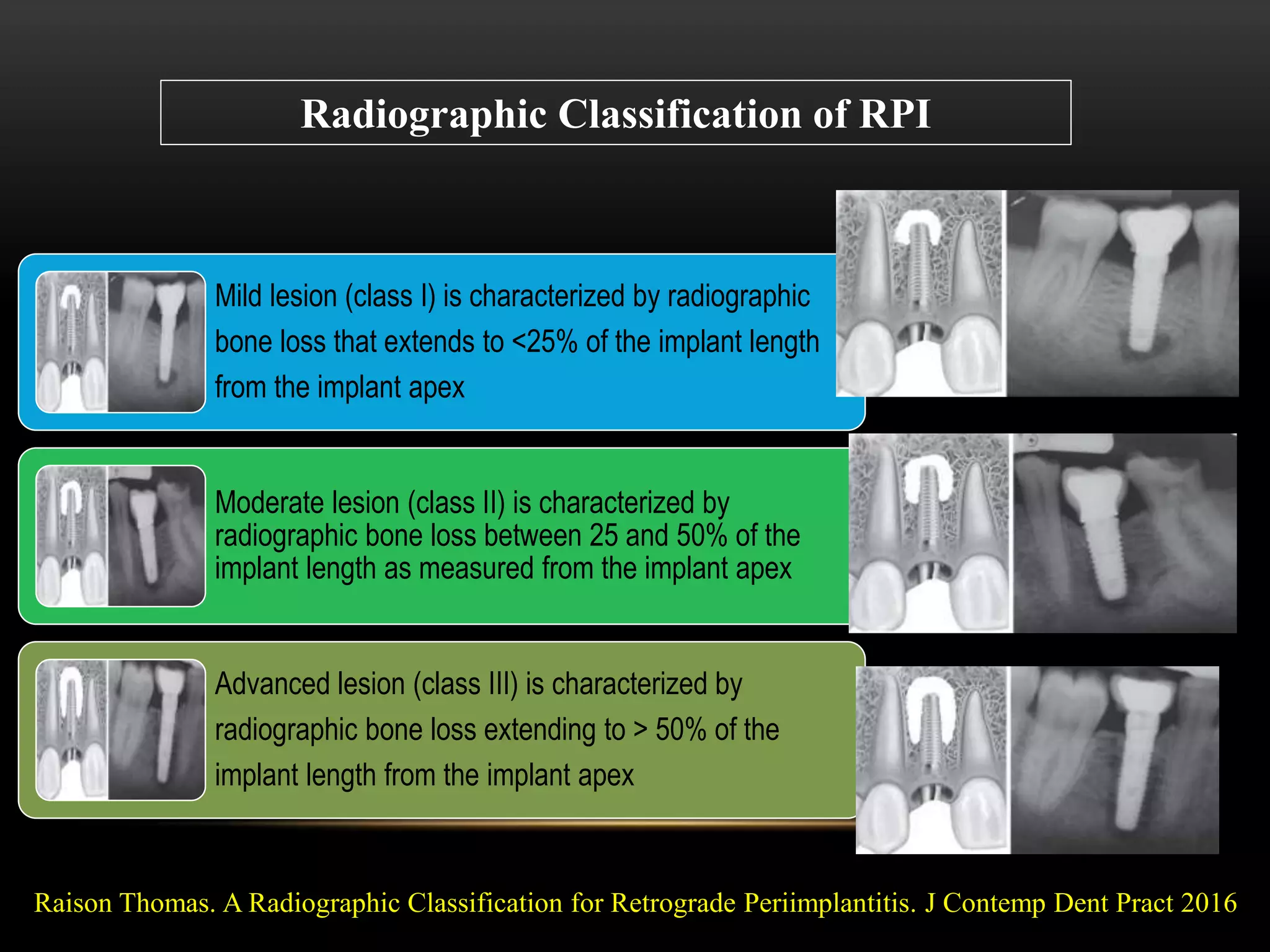 Periimplantitis | PPTX