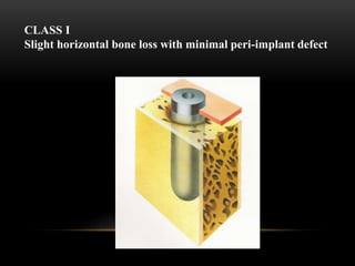Periimplantitis | PPTX