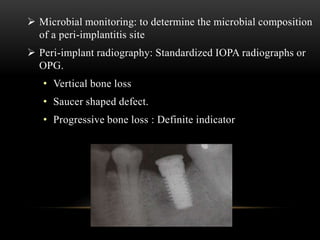 Periimplantitis | PPTX