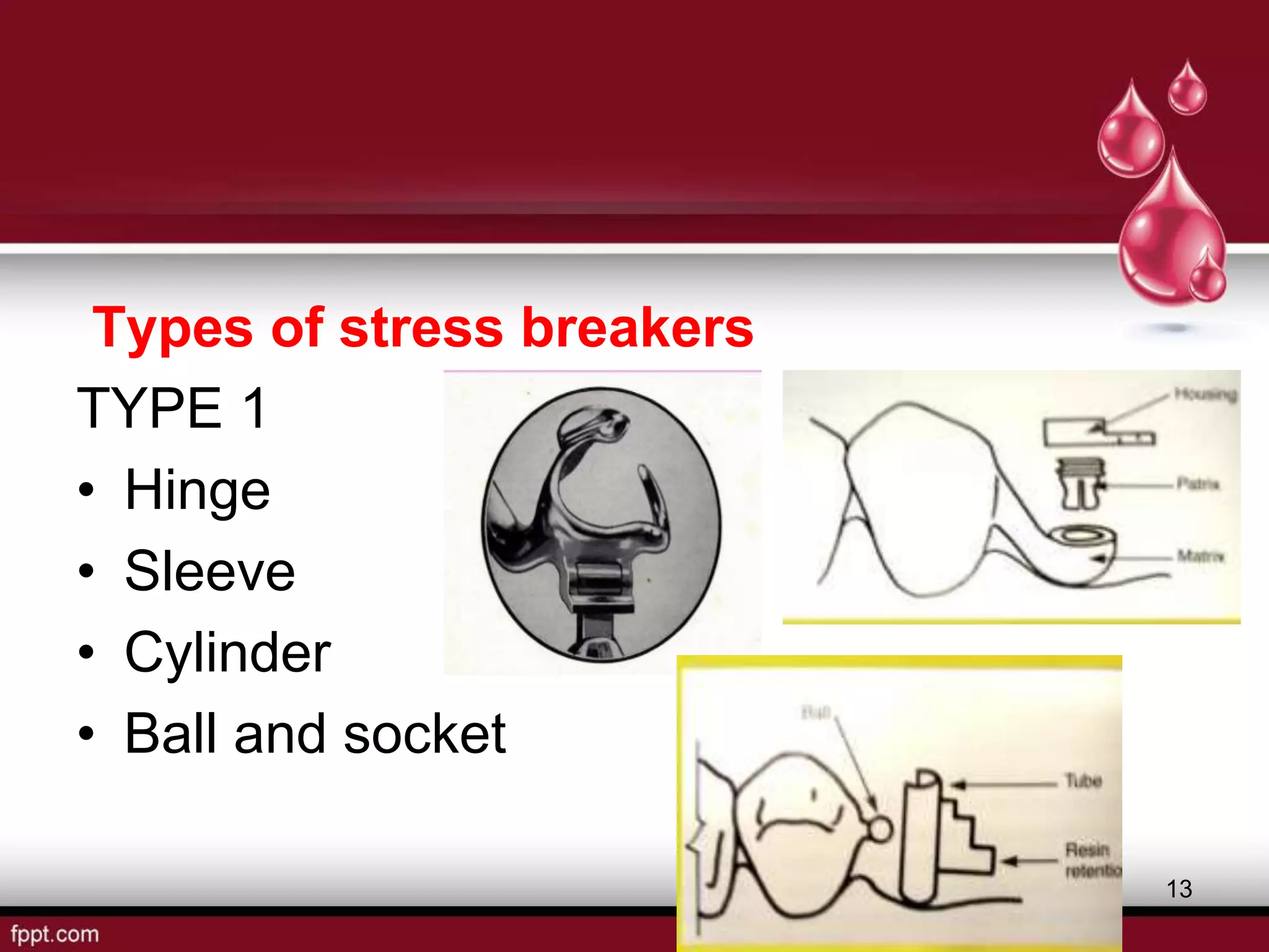 stress breakers in prosthodontics | PPTX