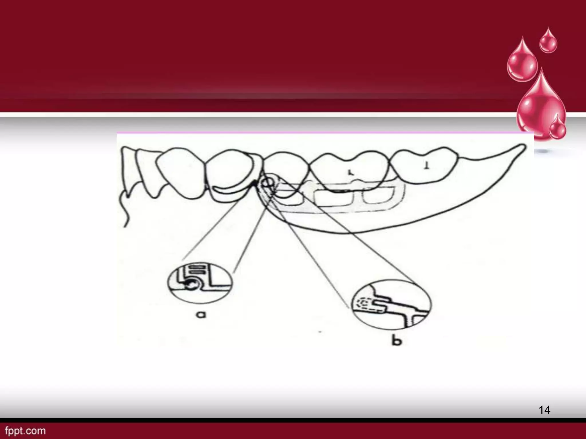 stress breakers in prosthodontics | PPTX