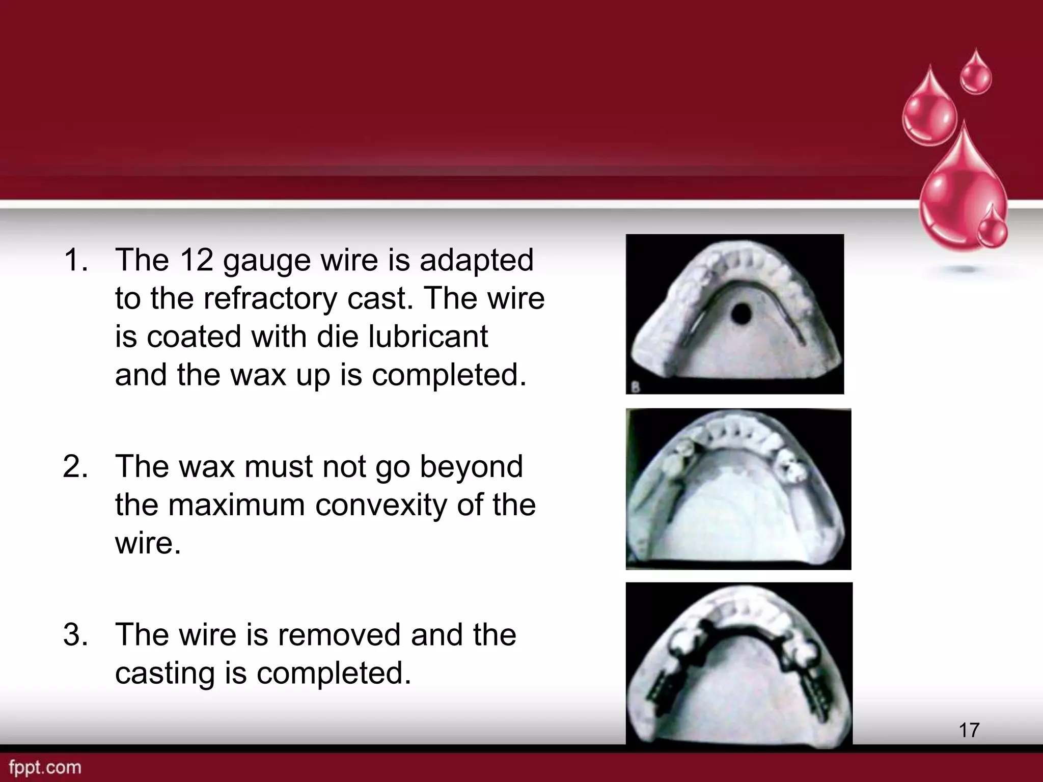 stress breakers in prosthodontics | PPTX