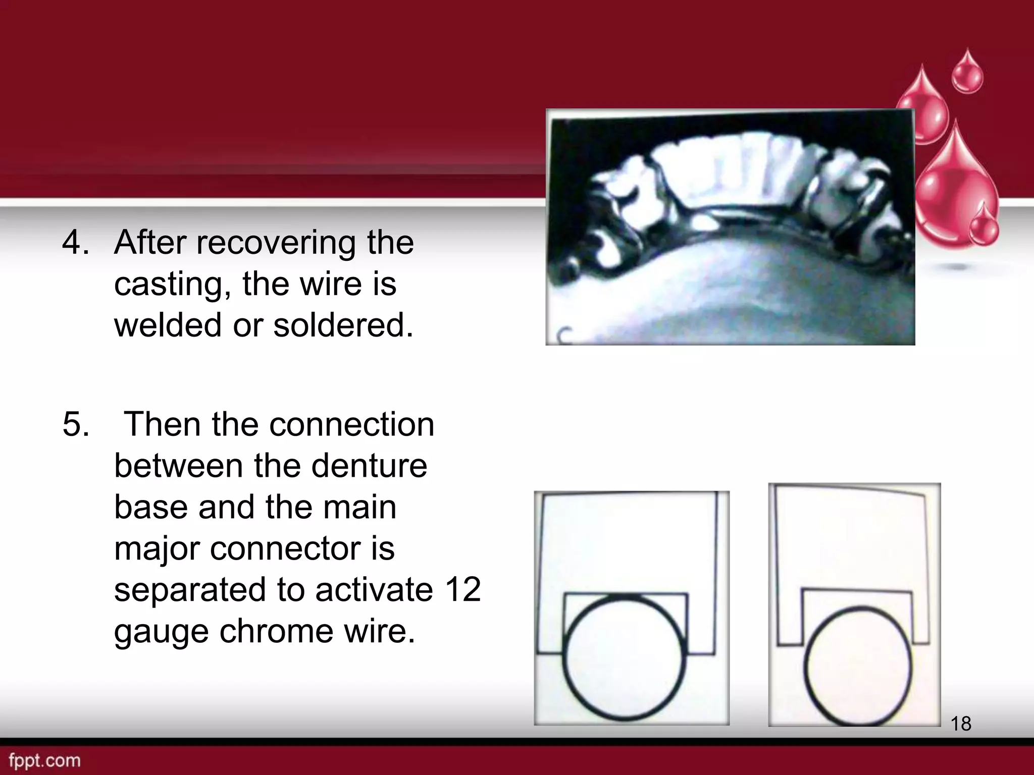 stress breakers in prosthodontics | PPTX