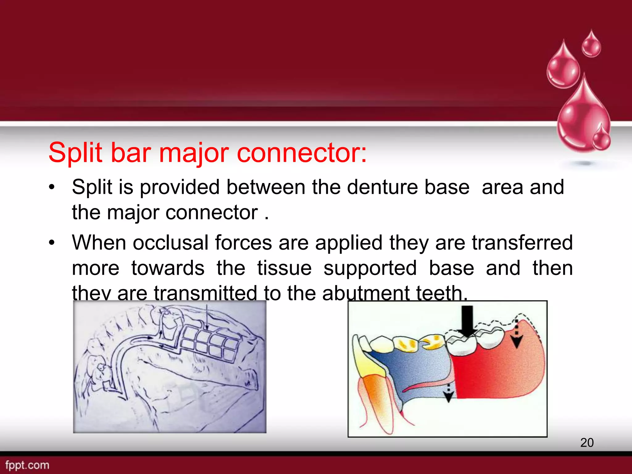 stress breakers in prosthodontics | PPTX