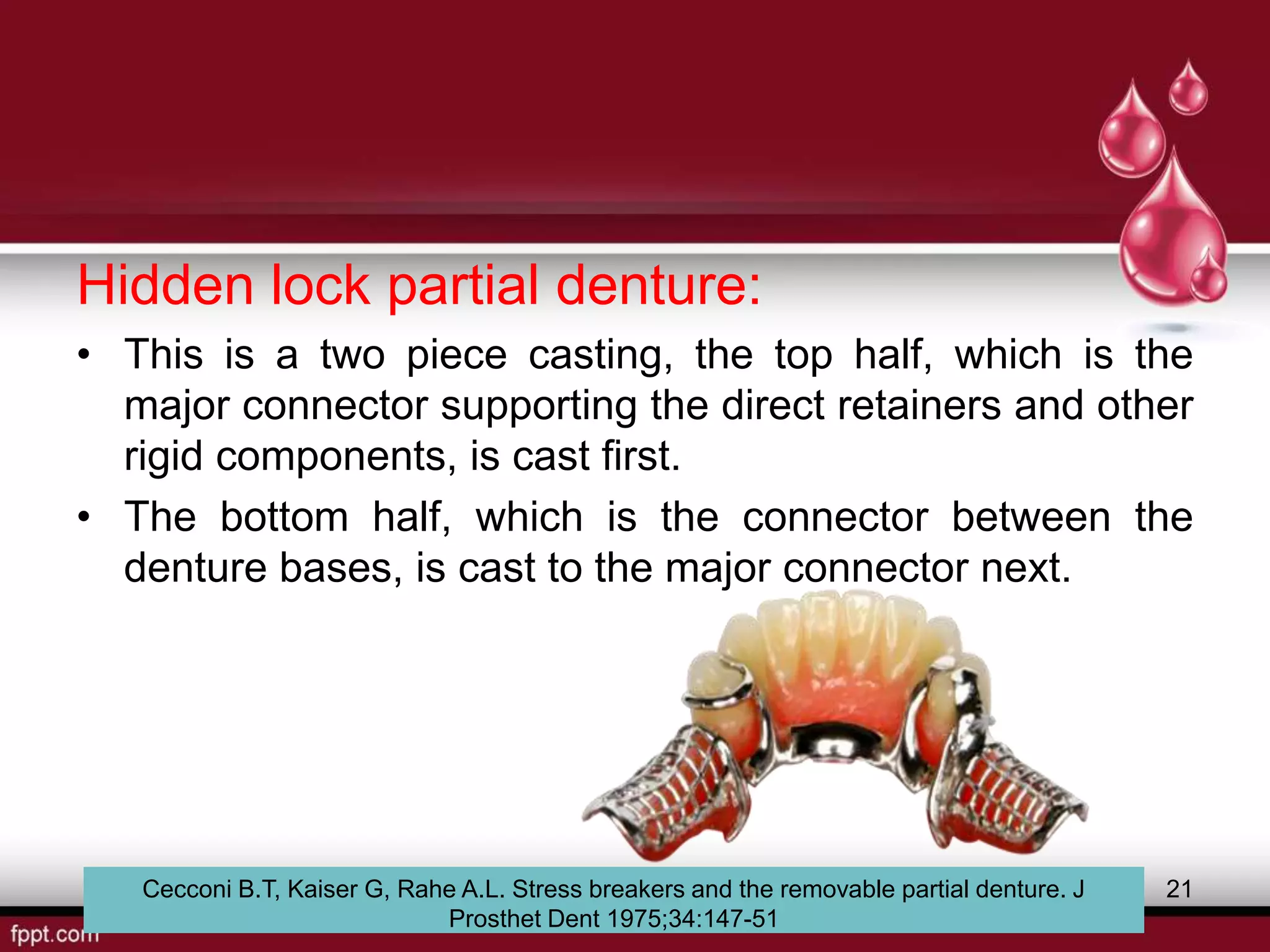 stress breakers in prosthodontics | PPTX
